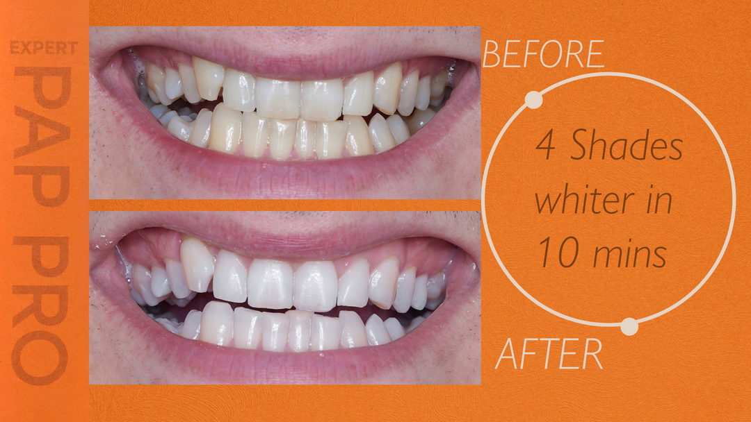 Expert PAP Pro Teeth Whitening Pen – L(A)B=LIFE+BEAUTY